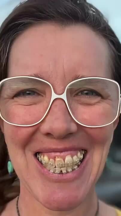 Woman With Severe Crooked Teeth Undergoes Jaw Expansion Surgery | Jukin ...