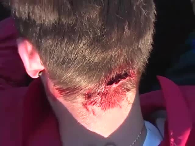 Bloody Back of Head Injury | Jukin Licensing