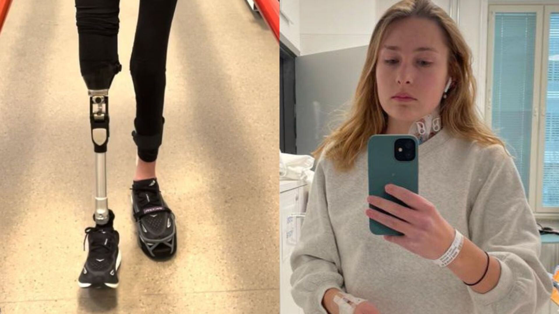 Woman Shares Her Journey to Recovery With Bionic Leg | Jukin Licensing